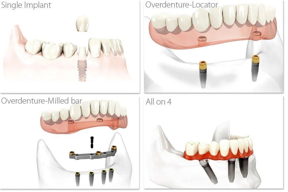 Dental Implants Los Angeles CA | Replace Missing Teeth